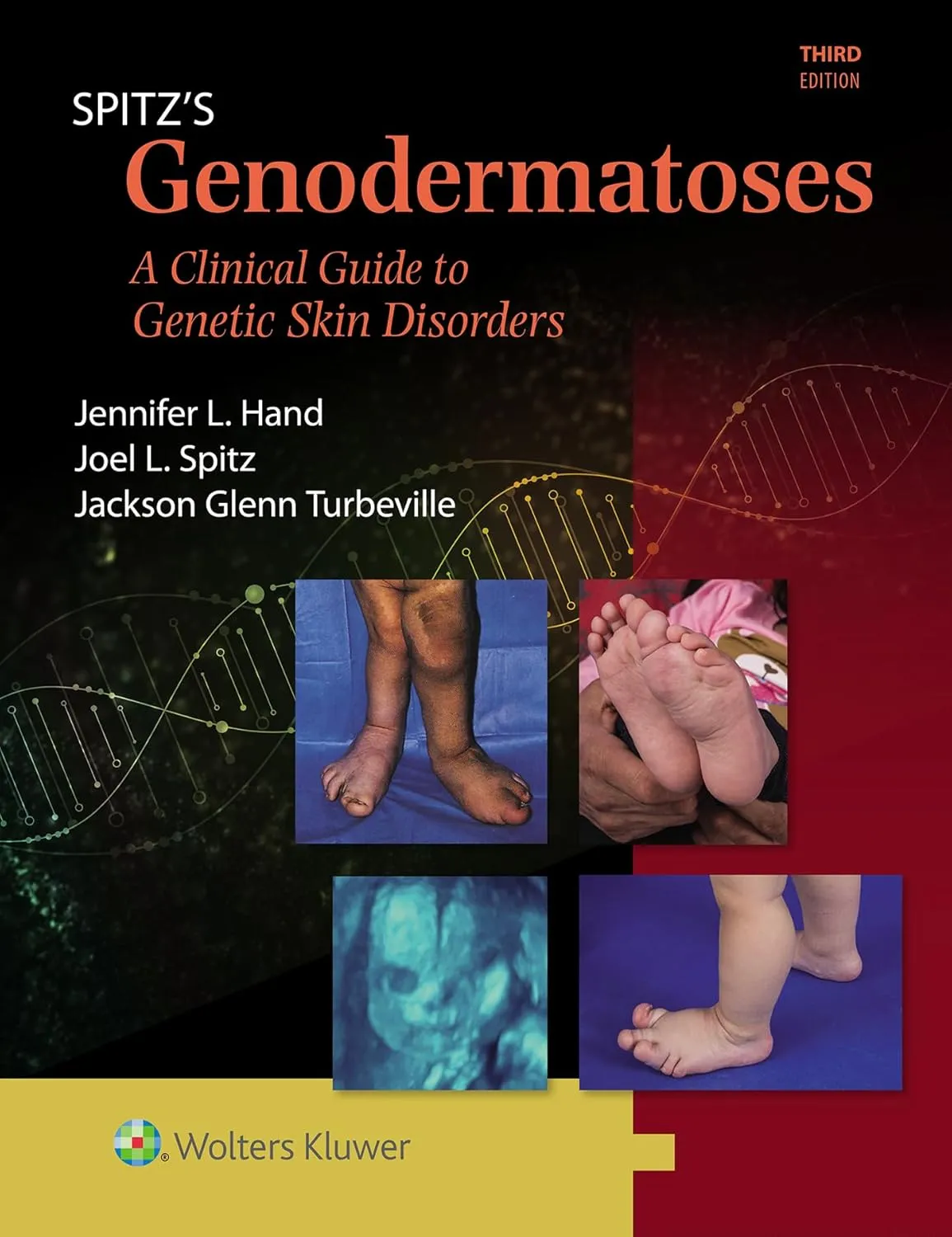 Spitz's Genodermatoses: A Clinical Guide to Genetic Skin Disorders