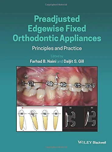 Preadjusted Edgewise Fixed Orthodontic Appliances: Principles and Practice