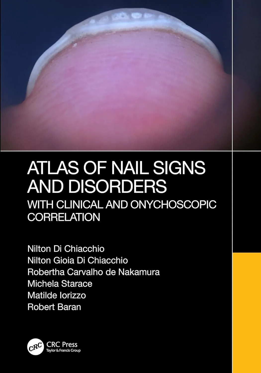 Atlas of Nail Signs and Disorders with Clinical and Onychoscopic ...
