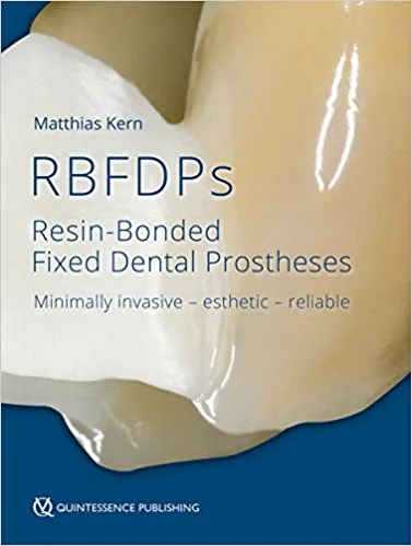 Rbfdps: Resin-bonded Fixed Dental Prostheses